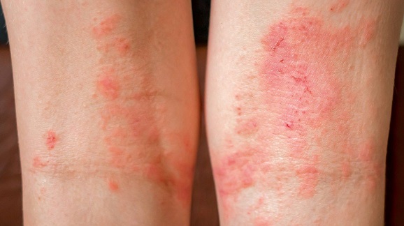 JENIS-JENIS RAWATAN ECZEMA - Renora Clinic