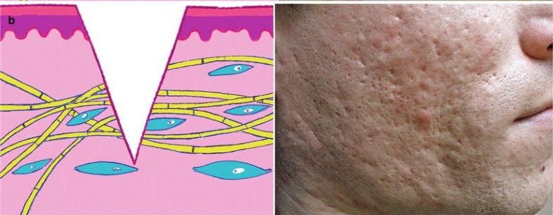 RAWATAN PARUT BERLUBANG - Renora Clinic