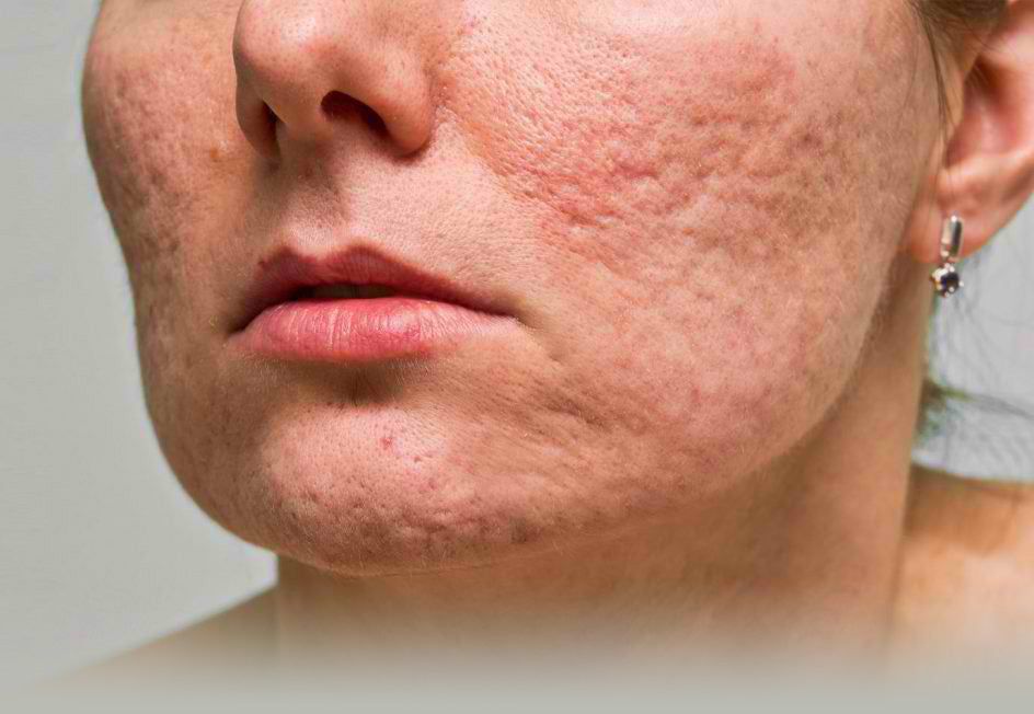 RAWATAN PARUT BERLUBANG - Renora Clinic