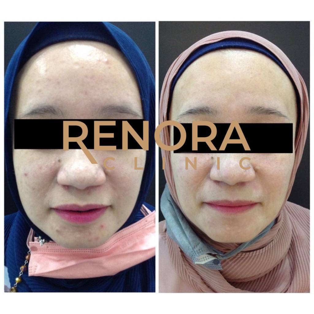 Renora Clinic - Professional Certified Aesthetic Clinic
