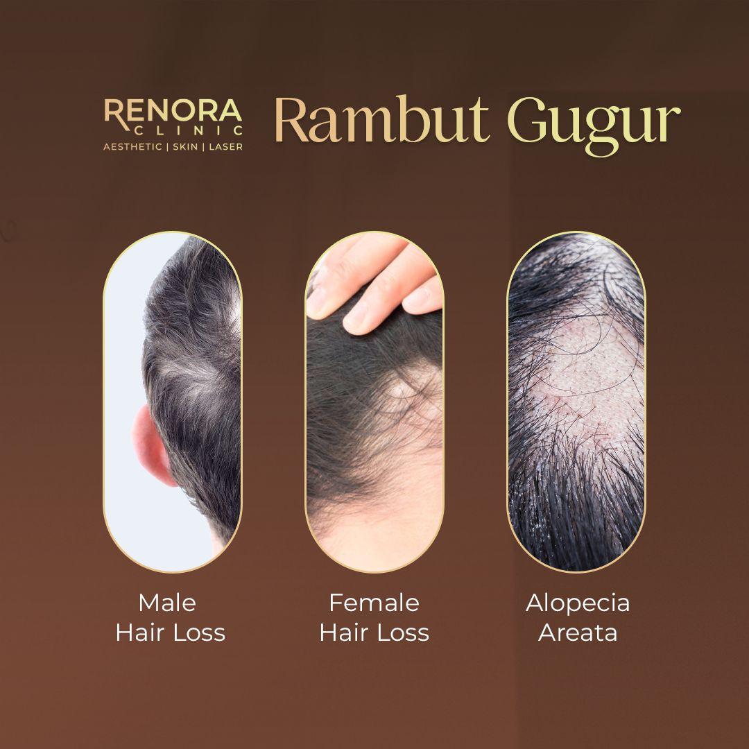5 Sebab Rambut Gugur Dan Rawatan Keguguran Rambut Di Renora Clinic ...